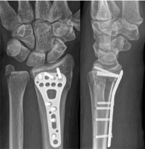 Platte_02 – Handchirurgie Dr. Paul Preisser
