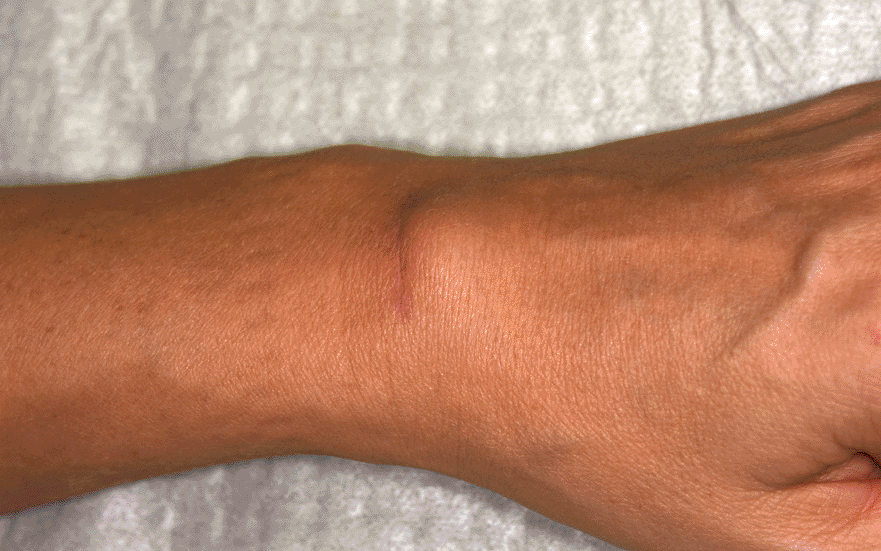 tumor – Handchirurgie Dr. Paul Preisser