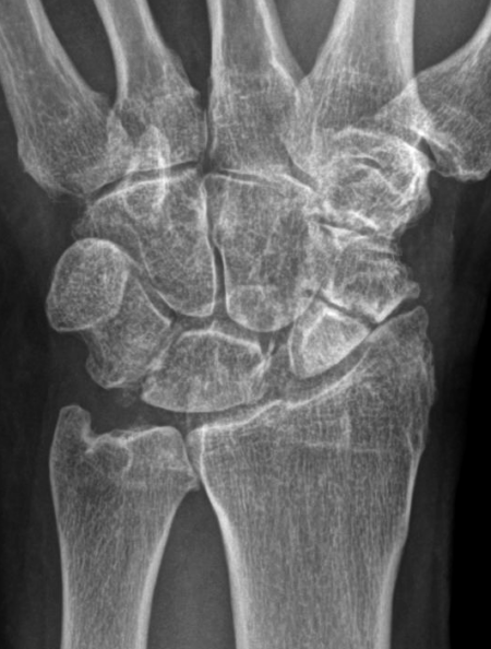 Arthrose nach Kahnbeinfraktur – Handchirurgie Dr. Paul Preisser