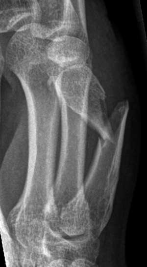 Mittelhandfraktur – Handchirurgie Dr. Paul Preisser