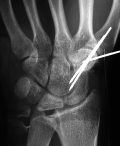 Mondbeinnekrose – Handchirurgie Dr. Paul Preisser