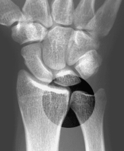 Radiusfraktur und Unterarmdrehung – Handchirurgie Dr. Paul Preisser