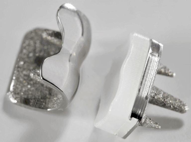 Arthrose am Fingermittelgelenk („Bouchard-Arthrose“) – Handchirurgie Dr ...