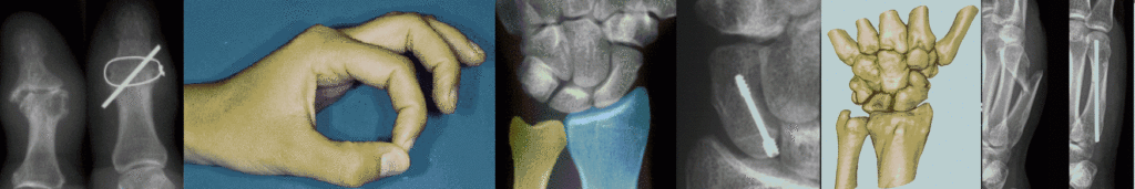 Kapselriss am Fingermittelgelenk – Handchirurgie Dr. Paul Preisser