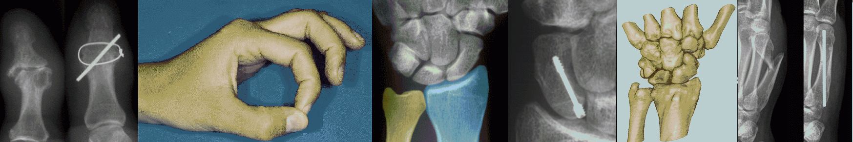 Kapselriss am Fingermittelgelenk – Handchirurgie Dr. Paul Preisser