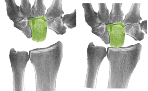 Entfernung der ersten Handwurzelreihe – Handchirurgie Dr. Paul Preisser