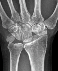 Entfernung der ersten Handwurzelreihe – Handchirurgie Dr. Paul Preisser