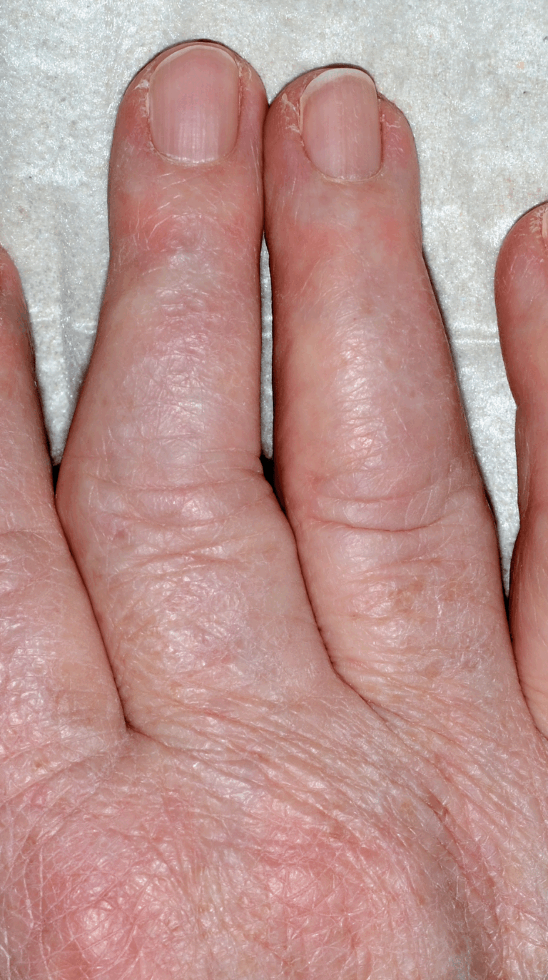 pip_01 – Handchirurgie Dr. Paul Preisser